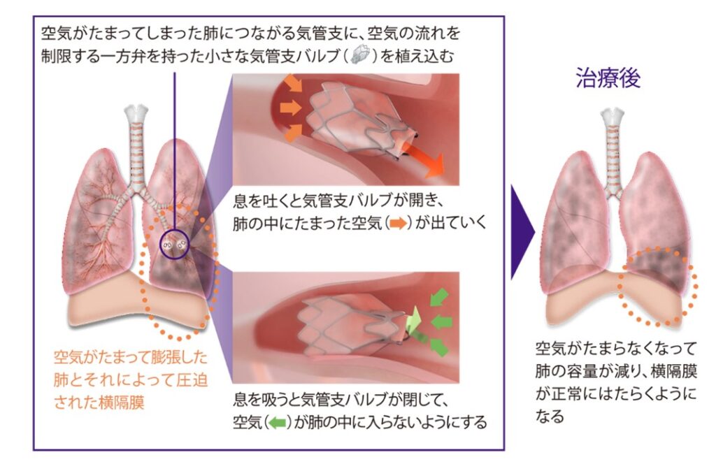 重症COPD治療における気管支鏡的肺容量減量術 峰下昌道教授 | 川村内科診療所様